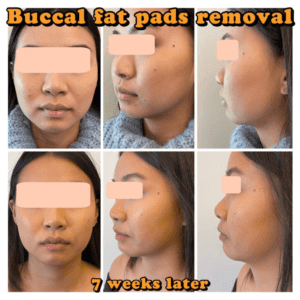 How to Prepare for Cheek Surgery - Harley Clinic