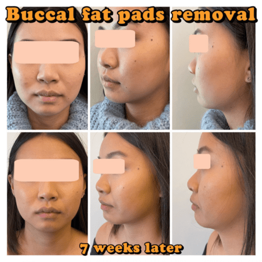 What are the Benefits of Cheek Reduction Surgery? - Harley Clinic