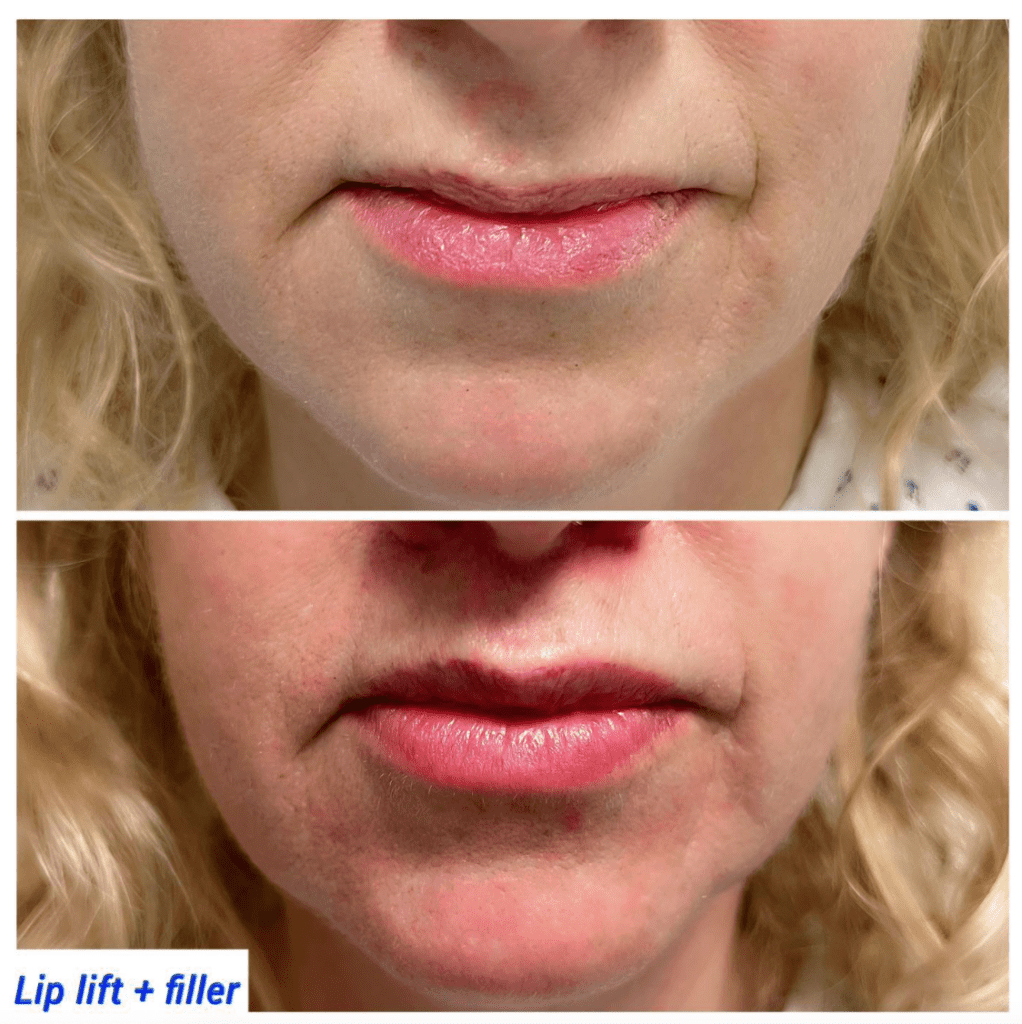 Fillers | Non-Surgical Procedures | Harley Clinic