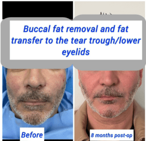 Fat Transfer to Face | Plastic Surgery | Harley Clinic