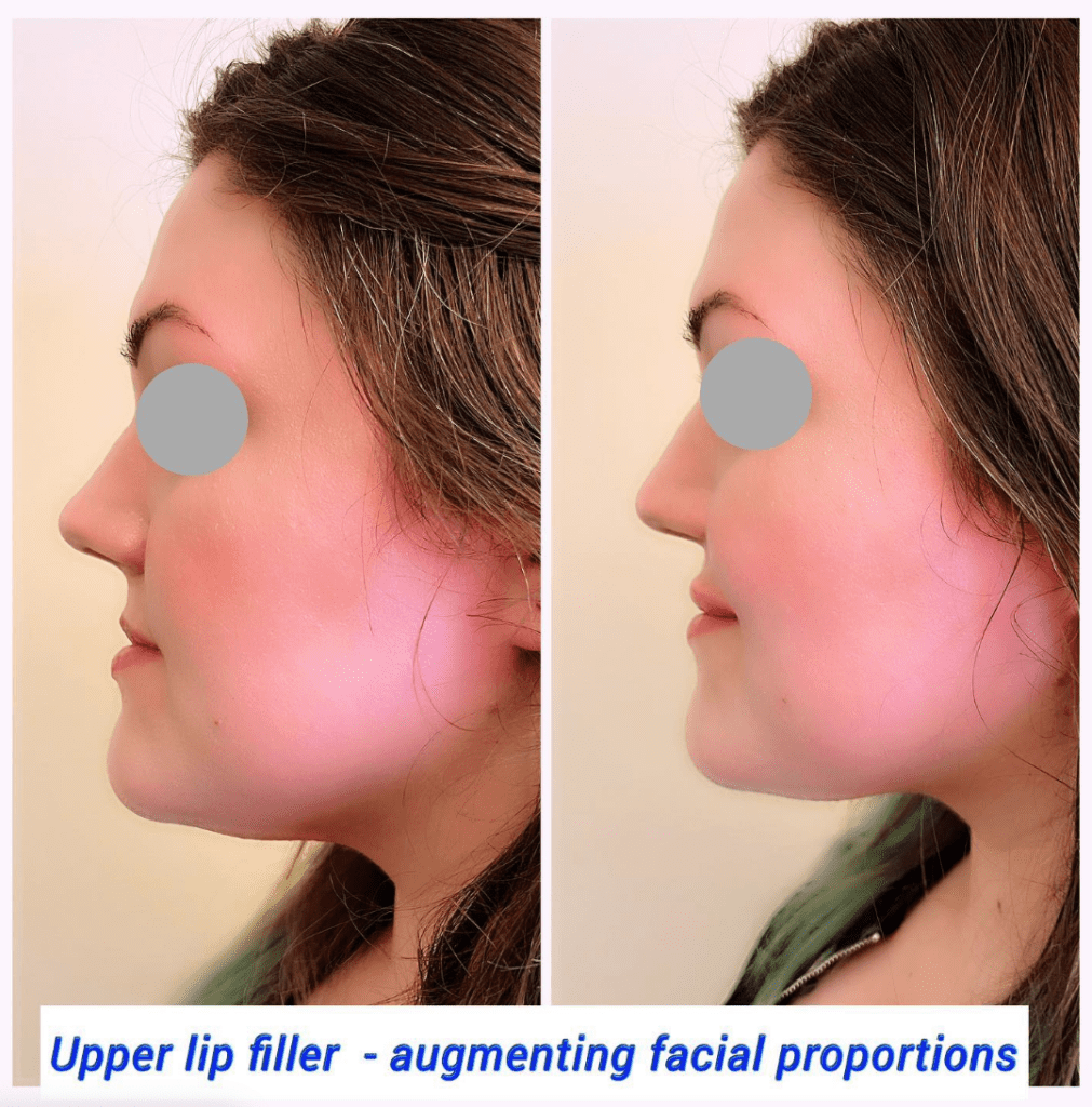 Fillers | Non-Surgical Procedures | Harley Clinic