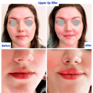How Long To Avoid Makeup After Lip Filler Infoupdate