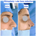 Alar Base Reduction (Nostril Reduction) - Harley Clinic