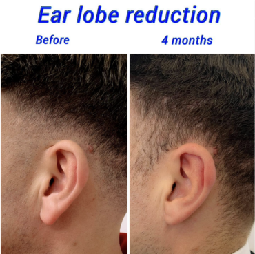 Earlobe Reduction Surgery | Ear Surgery - Harley Clinic