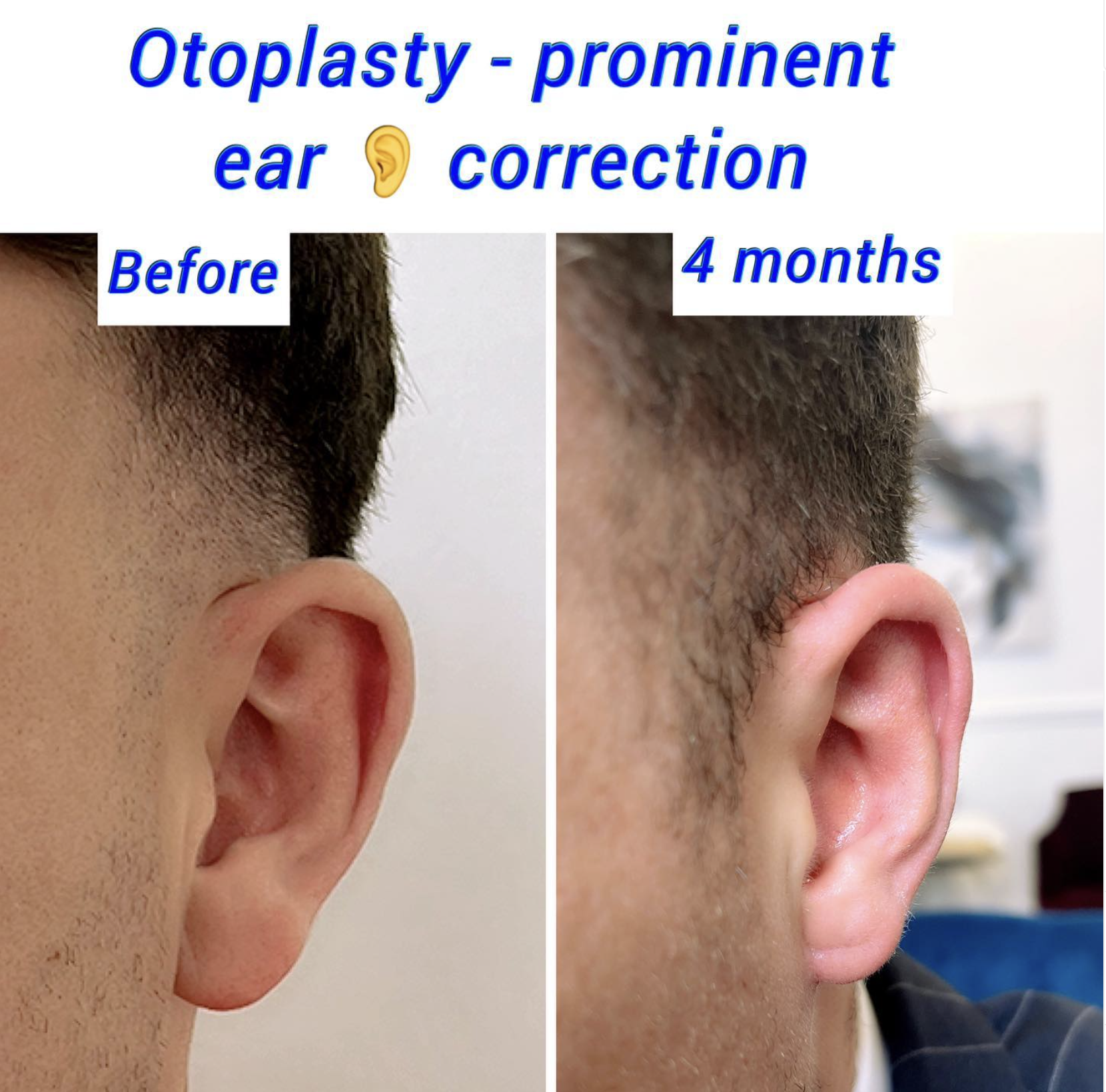 Ear Correction Surgery | Plastic Surgery | Harley Clinic