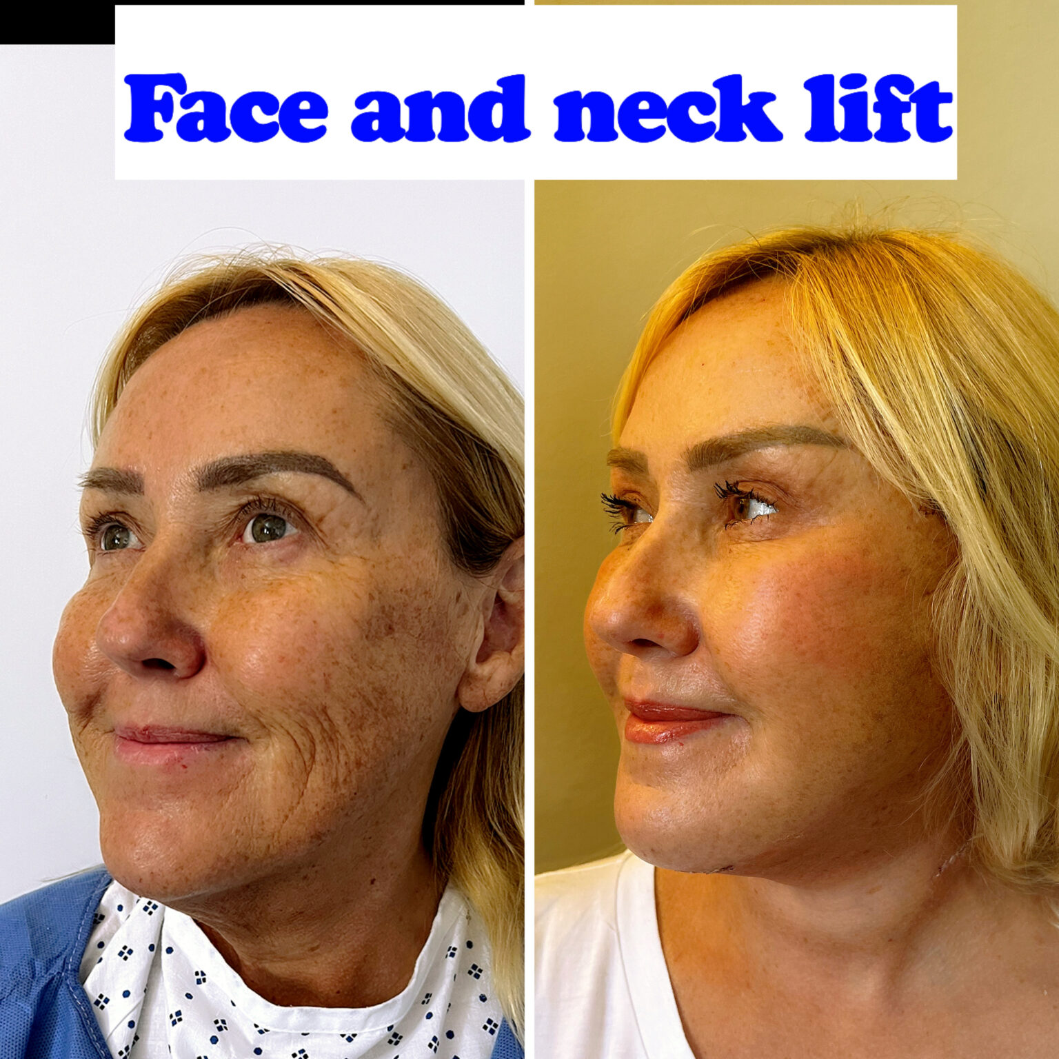 How to Get Rid of Jowls with a Neck Lift