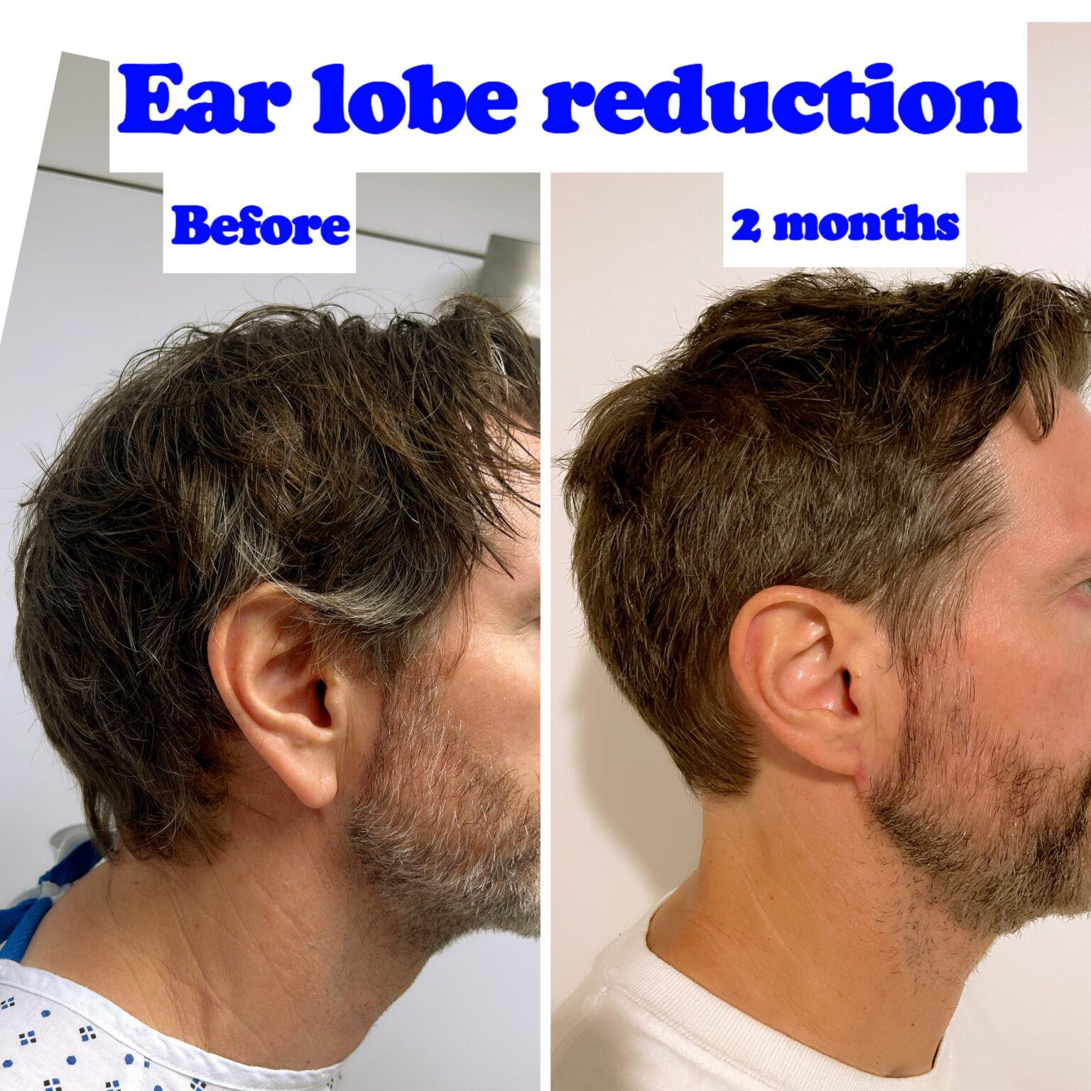 Earlobe Reduction Surgery | Ear Surgery - Harley Clinic