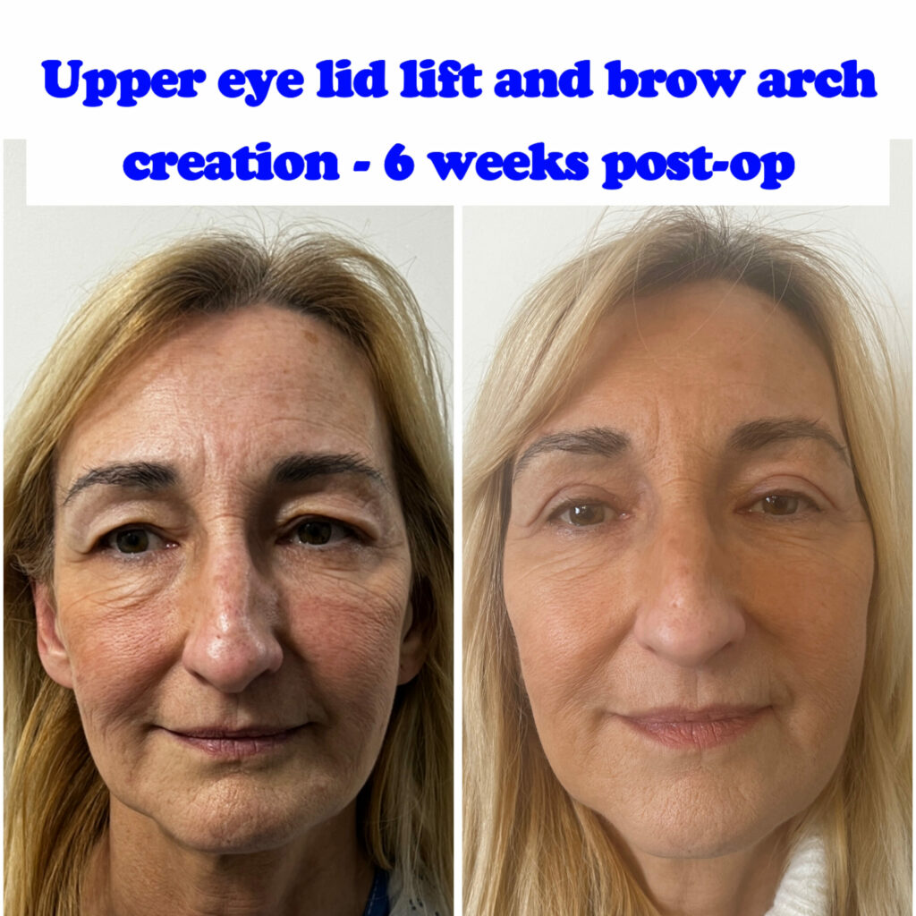 Surgery for Droopy Eyelid: 5 Things You Need to Know