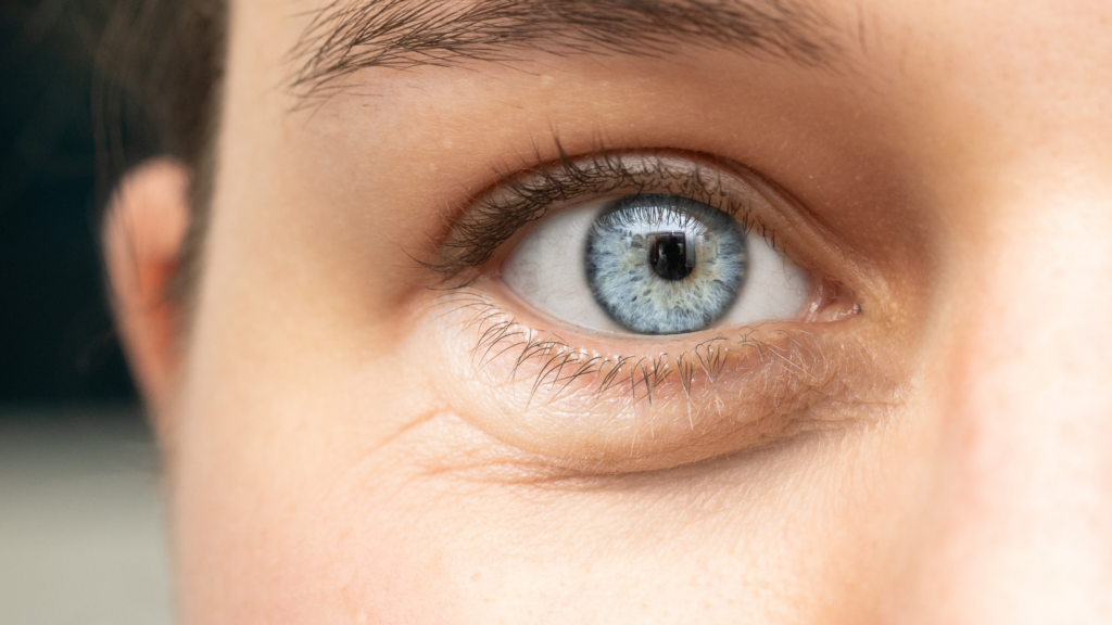 Under Eye Bags: What Causes Them and How to Get Rid of Them for Good