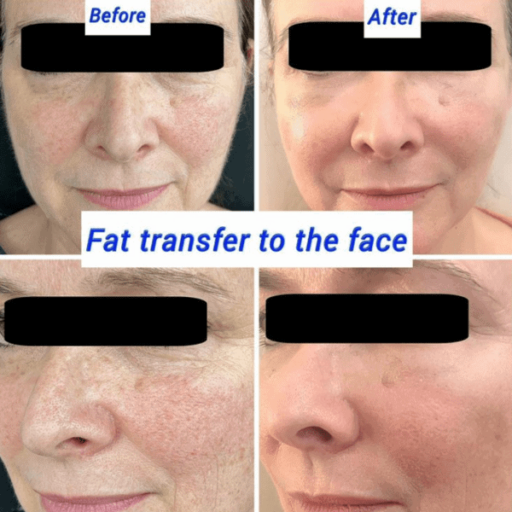 Fat Transfer for Face: A More Permanent Solution for Volume Loss