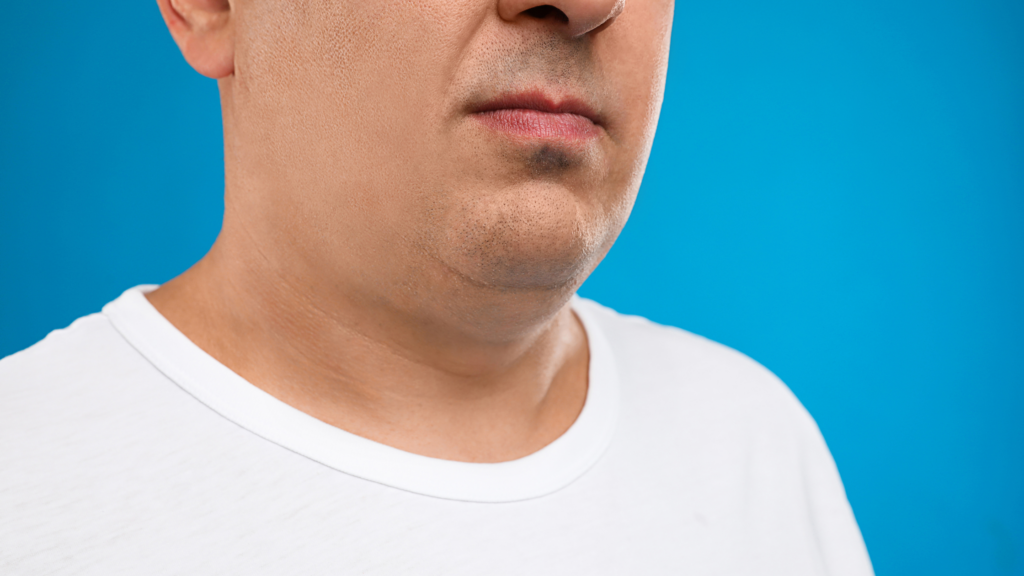 Double Chin Removal: Sculpting the Lower Face
