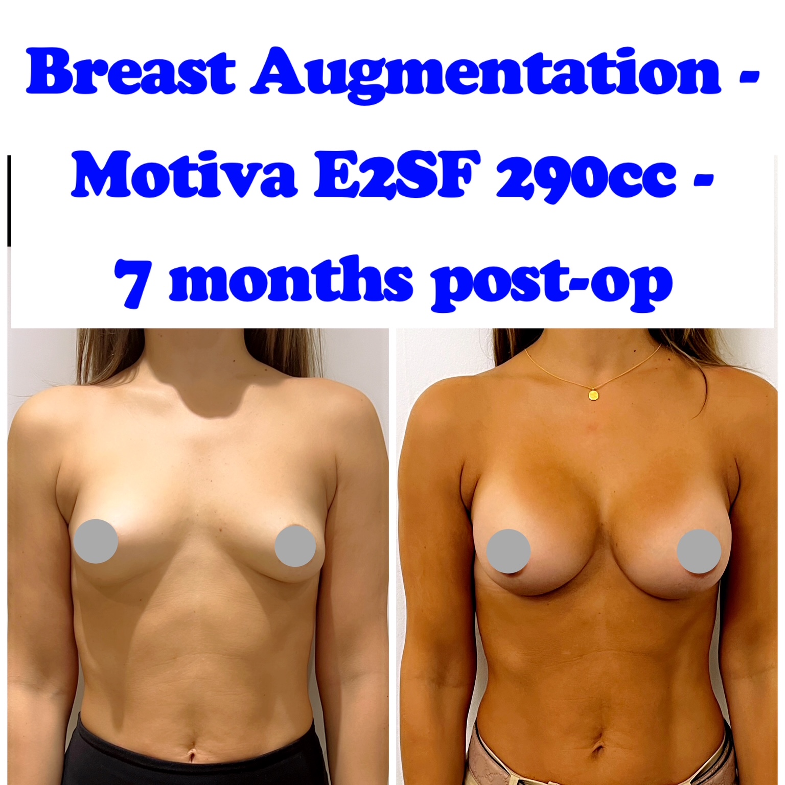 D Cup Breast Implants