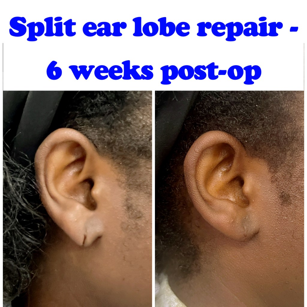 Split Earlobe Correction | Plastic Surgery | Harley Clinic